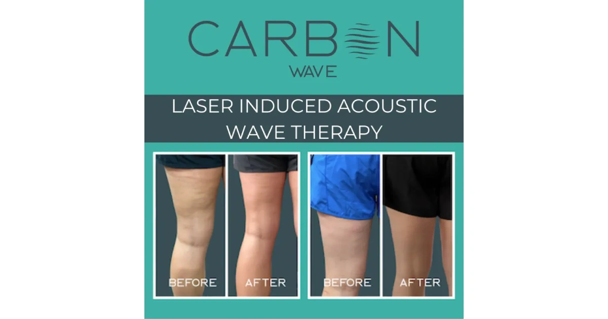 Carbon Wave Cellulite Treatment Before & After | 1Aesthetic